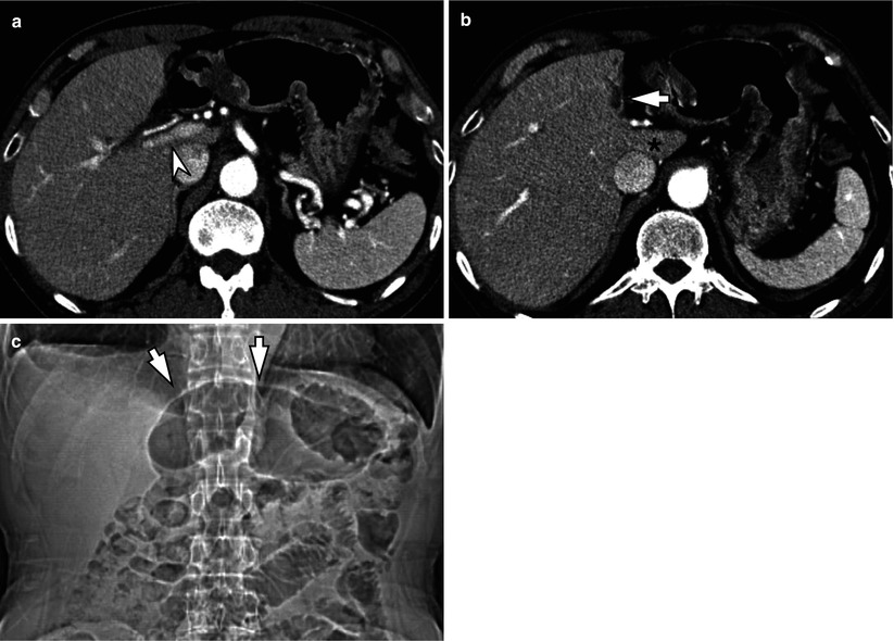 Anomalies and Anatomic Variants of the Liver | SpringerLink