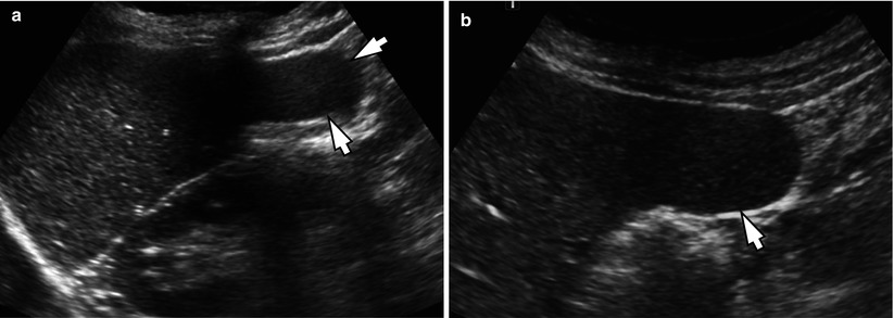 Anomalies and Anatomic Variants of the Liver | SpringerLink