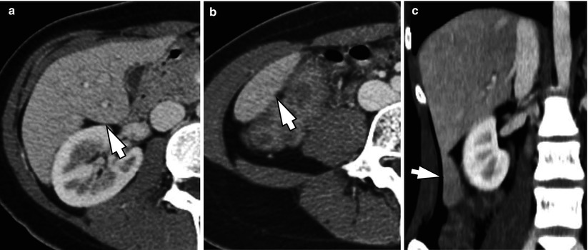 Anomalies and Anatomic Variants of the Liver | SpringerLink