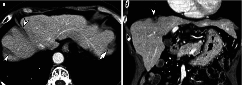 Anomalies and Anatomic Variants of the Liver | SpringerLink