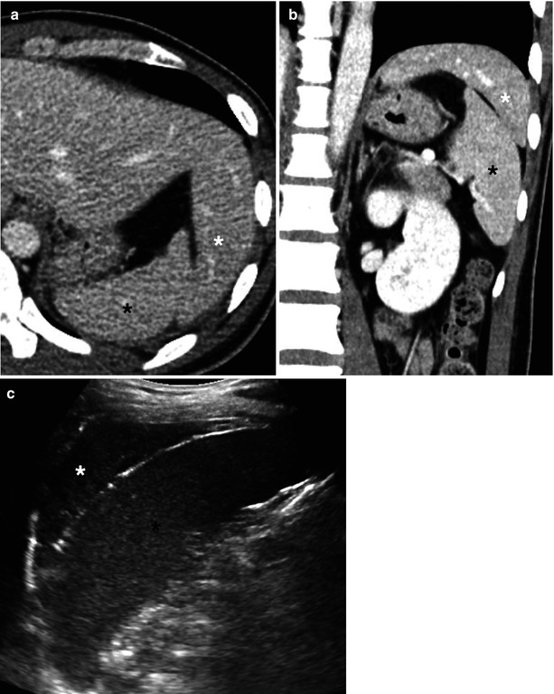 Anomalies and Anatomic Variants of the Liver | SpringerLink