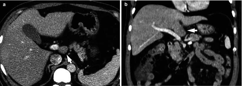Anomalies and Anatomic Variants of the Liver | SpringerLink