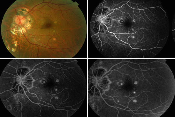 Punctate Inner Choroidopathy | SpringerLink