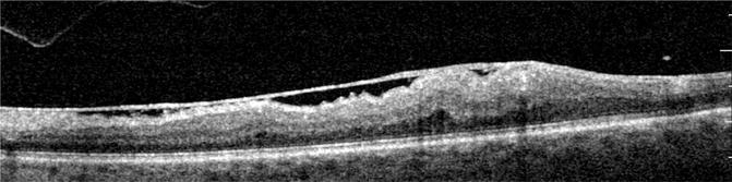 Cellophane Maculopathy | SpringerLink