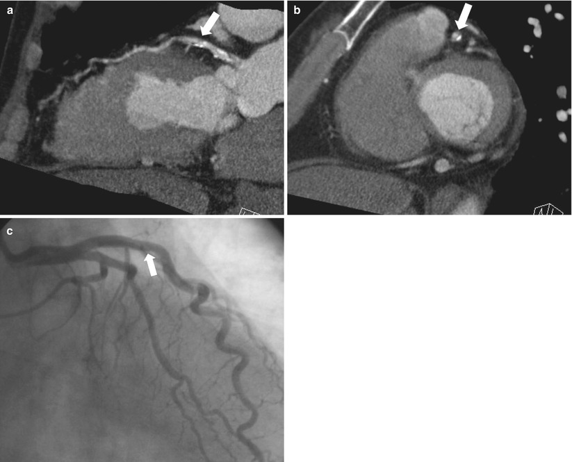 Atherosclerotic Coronary Artery Disease | SpringerLink