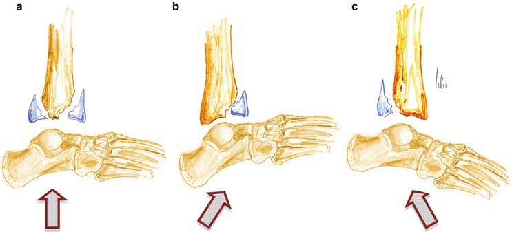 Fractures of the Tibial Pilon | SpringerLink
