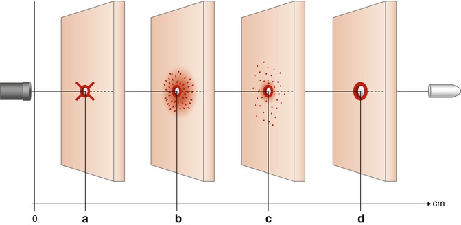 Gunshot and Blast Wounds | SpringerLink