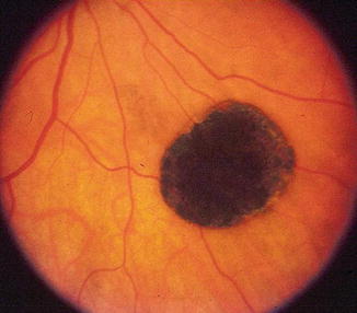Retinal Pigment Epithelial Tumors | SpringerLink