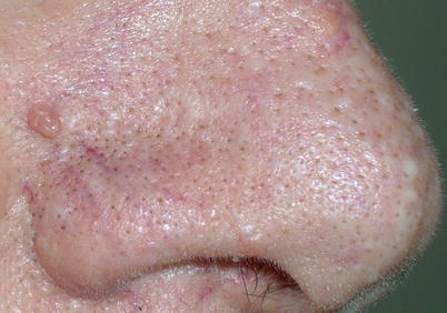 Benign Fibrohistiocytic Tumors and Proliferations | SpringerLink