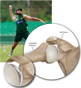 SLAP Lesions Part II: Acute Lesion Versus Chronic Lesion Resulting from ...