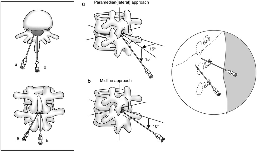 Anesthesia for Anal Surgery | SpringerLink