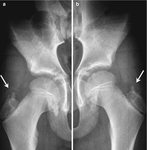 The Pelvis and Hip: Congenital and Developmental Conditions | SpringerLink