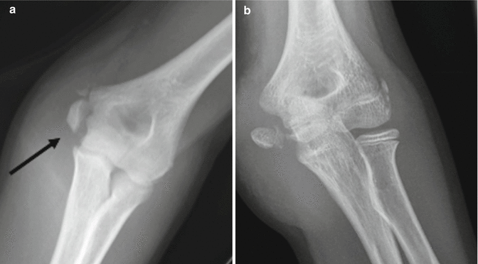 The Elbow and Forearm: Acquired Disorders | SpringerLink
