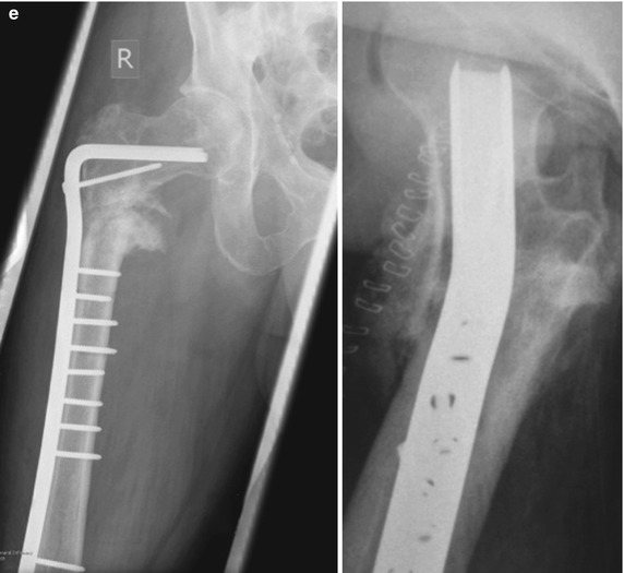 Bone Healing: The Diamond Concept | SpringerLink