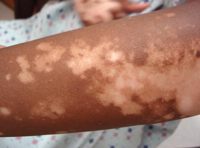 Vitiligo | SpringerLink