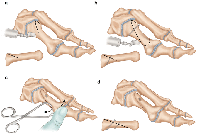 Hallux Valgus and Bunionette | SpringerLink