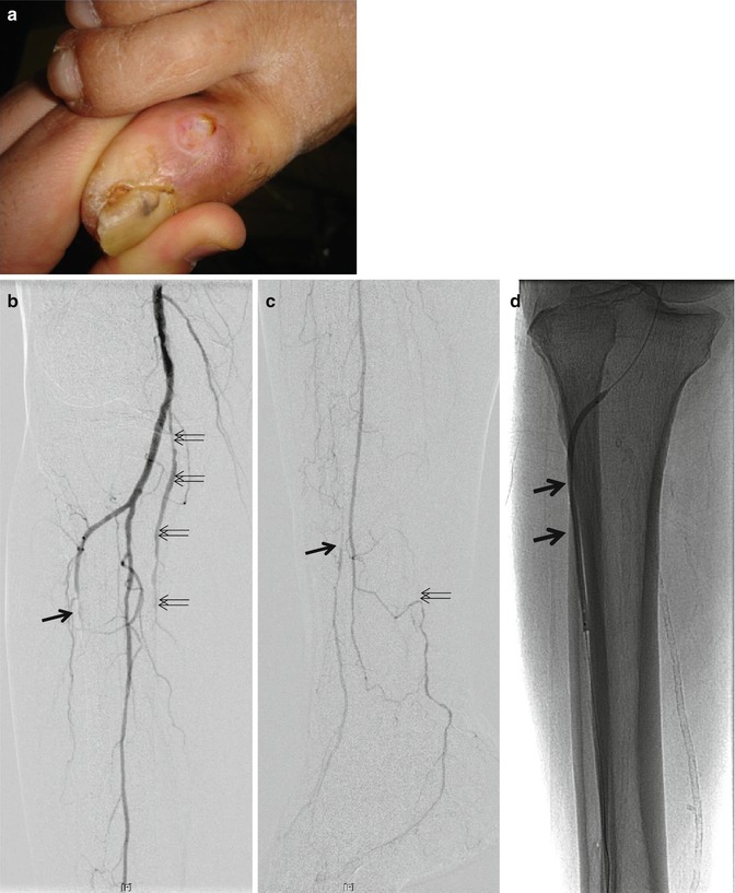 Diabetic Foot: Ulcer, Infection, Ischemic Gangrene | SpringerLink