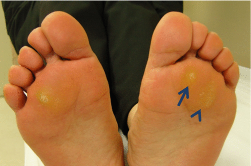 Metatarsalgia and Toe Deformities | SpringerLink