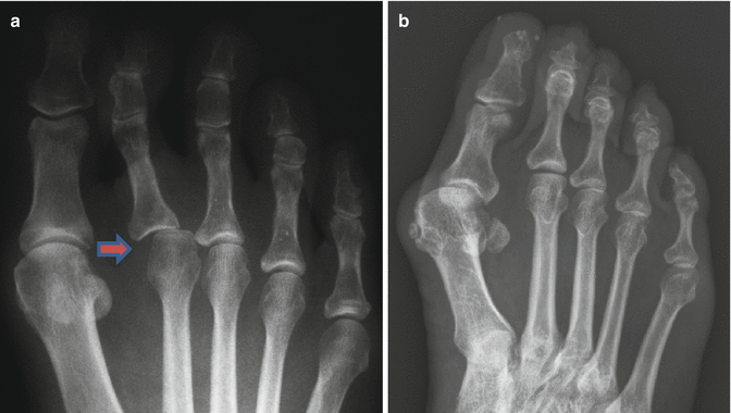Metatarsalgia and Toe Deformities | SpringerLink