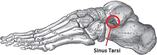 Osteochondral Lesion of Talus, Ankle Impingement, and Sinus Tarsi ...