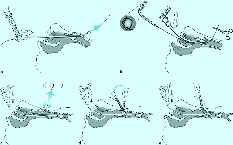 Atemwegsmanagement | SpringerLink