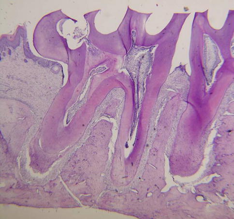 Pulp Aging: Fibrosis and Calcospherites | SpringerLink