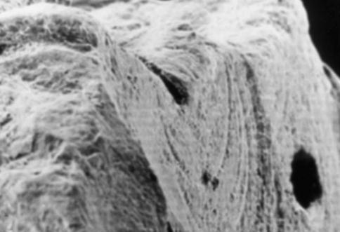 Pulp Aging: Fibrosis and Calcospherites | SpringerLink