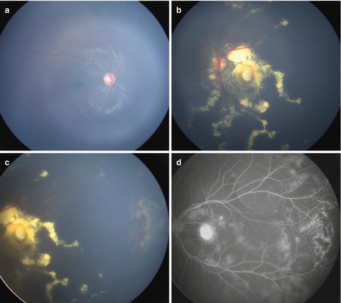 Differential Diagnosis of Leukocoria | SpringerLink