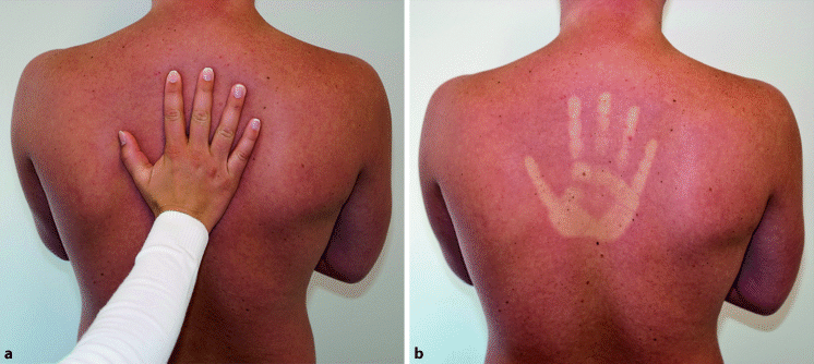 DD Exanthem und Fieber nach Tropenaufenthalt | SpringerLink