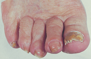 Dermatomykosen (Hautpilzerkrankungen) | SpringerLink