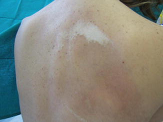 Morphea (Localized Scleroderma) | SpringerLink