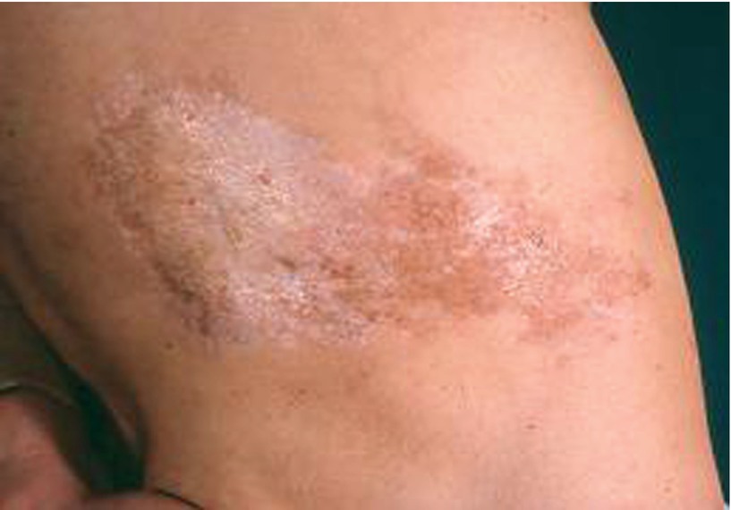Morphea (Localized Scleroderma) | SpringerLink