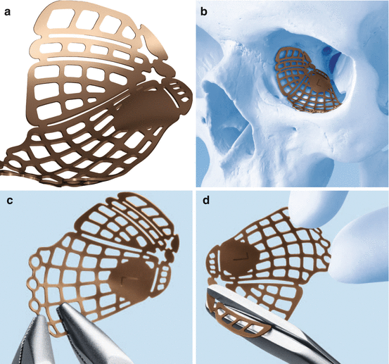 Orbital Floor Fractures | SpringerLink