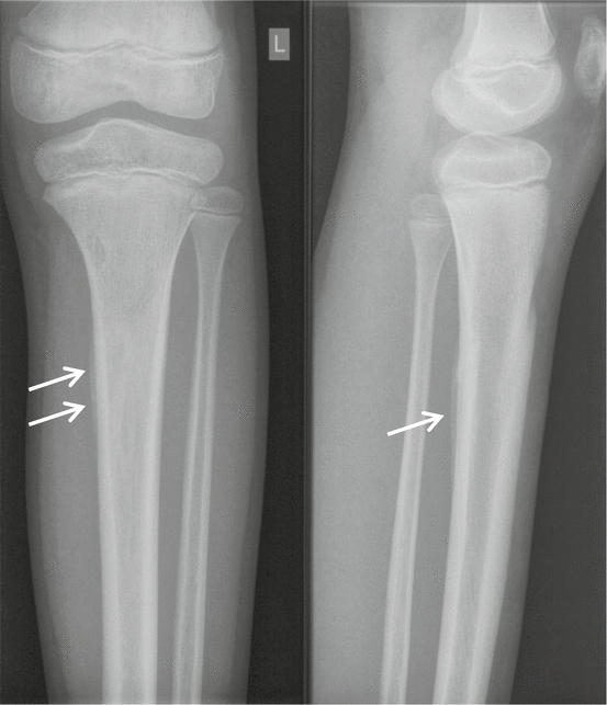 Radiologic Imaging of Lower Leg Injuries | SpringerLink