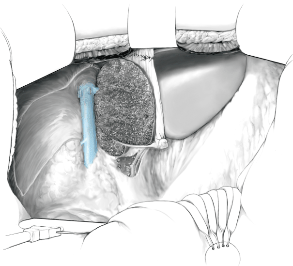 Extended Hemihepatectomy | SpringerLink
