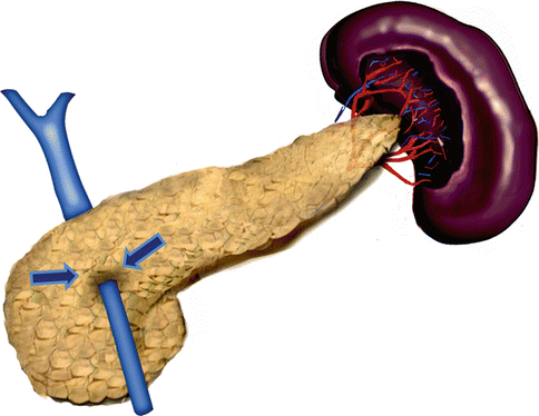 Embryology of the Pancreas and Normal Variants | SpringerLink