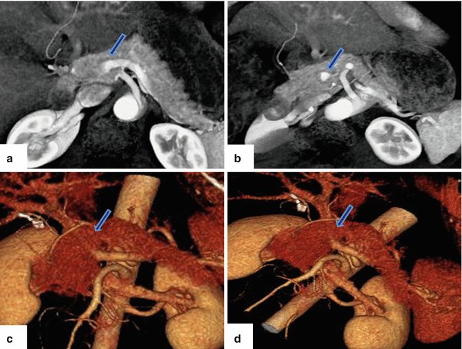 Embryology of the Pancreas and Normal Variants | SpringerLink