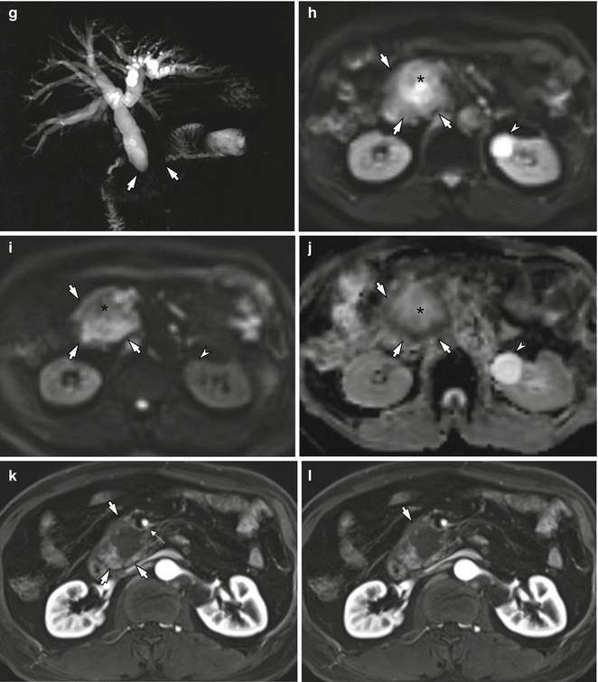 Imaging Diagnosis of Pancreatic Cancer: CT and MRI | SpringerLink