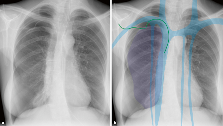 Gefäßzugänge | SpringerLink