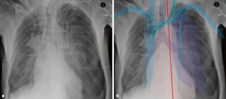 Gefäßzugänge | SpringerLink