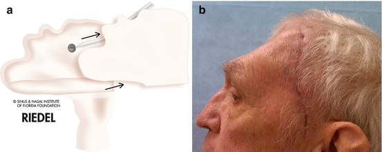 The Evolution of Frontal Sinus Surgery from Antiquity to the 21st ...
