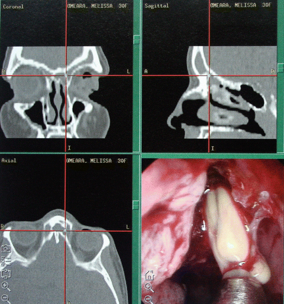Image-Guidance in Frontal Sinus Surgery | SpringerLink
