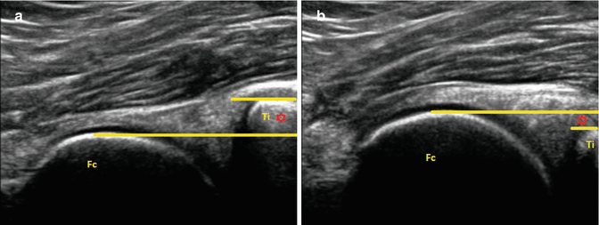 Meniscus Ultrasound | SpringerLink
