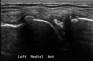 Meniscus Ultrasound | SpringerLink