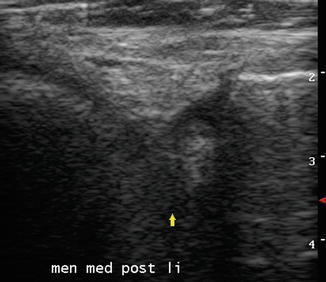 Meniscus Ultrasound | SpringerLink