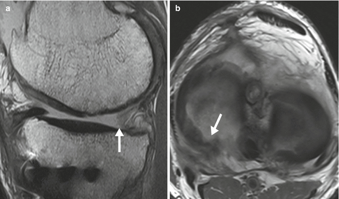 Postoperative Imaging of the Meniscus | SpringerLink
