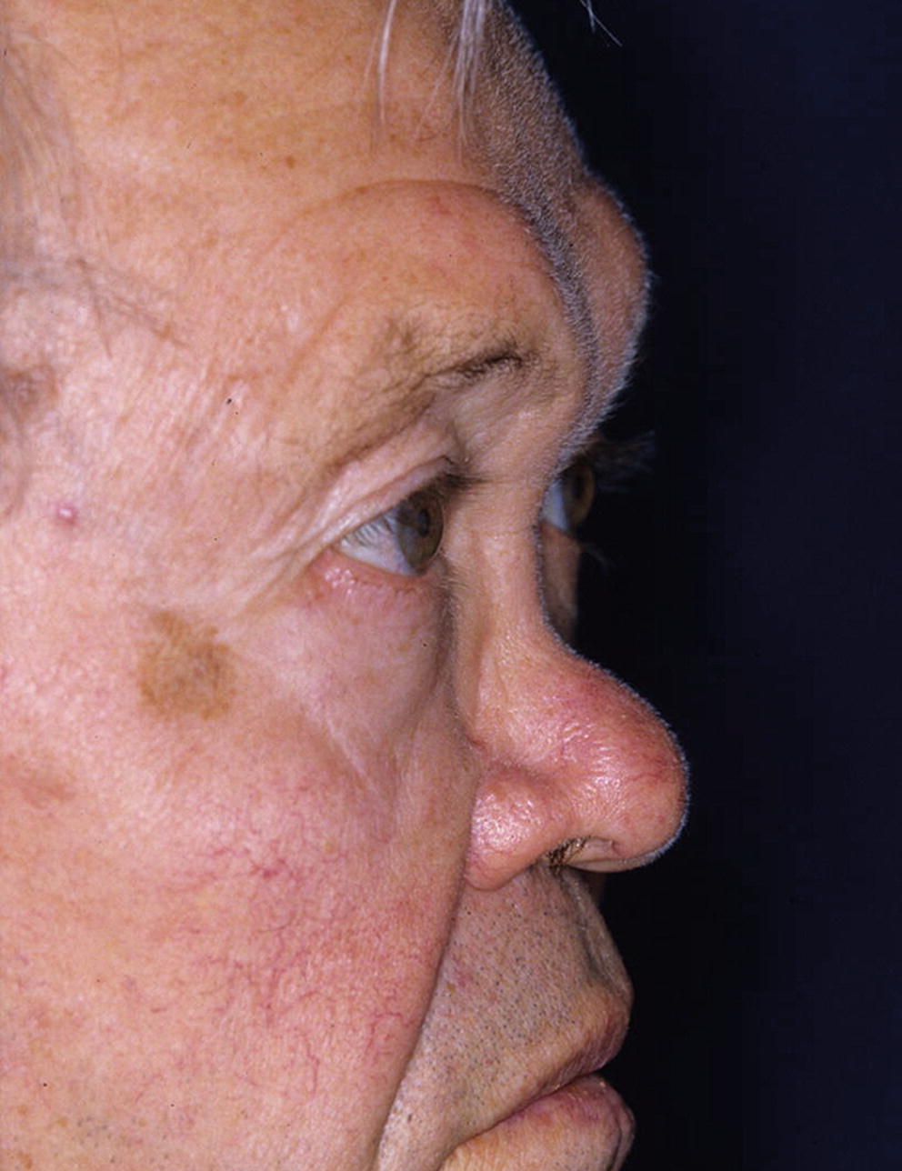 Syphilis | SpringerLink