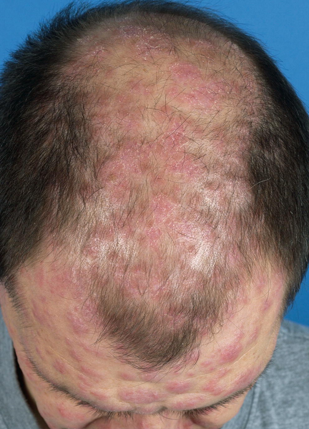 Syphilis | SpringerLink