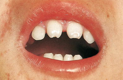 Syphilis | SpringerLink