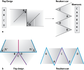 Gestielte Lappenplastiken | SpringerLink
